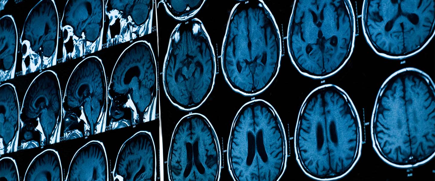 Neurocritical Care: The Ken & Ruth Davee Department of Neurology ...